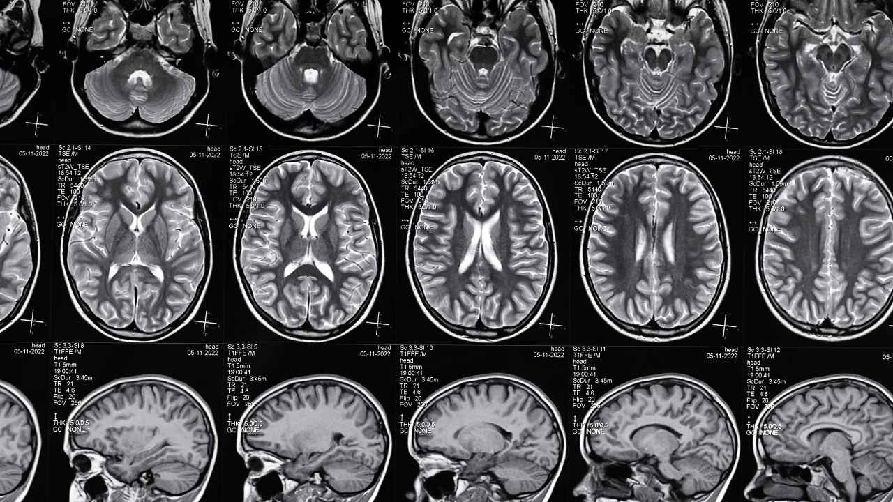 Traumatic Brain Injury Settlements in Florida | Meldon Law